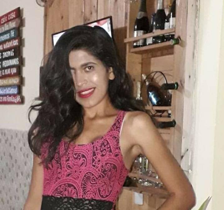 Luz, la joven que quiere un ojo postizo ya fue atendida por médicos